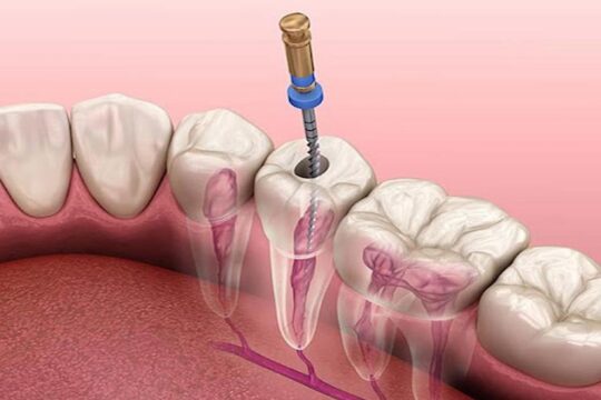Know How To Preserve Natural Teeth